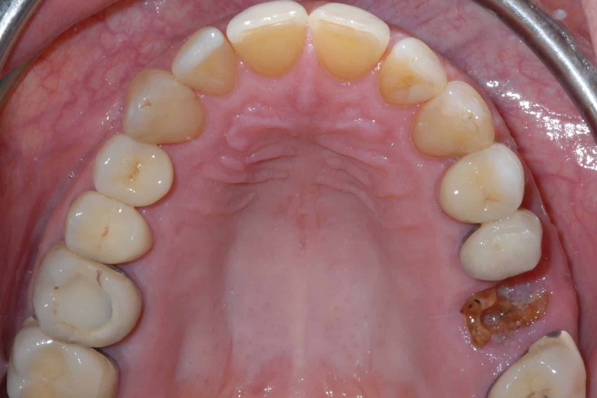 Implantologia nella zona molare il caso clinico di Giovanna - Clinica Villa