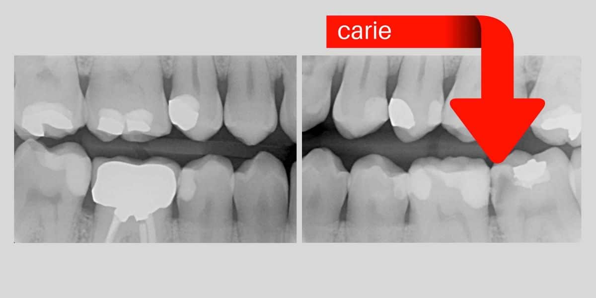 Carie dentale: sintomi, cause e cure (Aggiornato 2026) - Clinica Villa