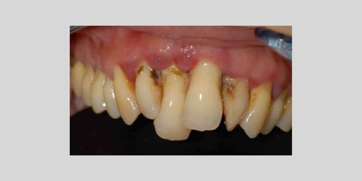 Tartaro le sette cose da sapere - Clinica Villa